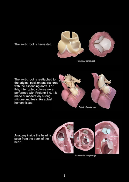 APCIS News - APCIS2022 C5-2 anatomic repair of cc-TGA VSD LVOT using 3d ...