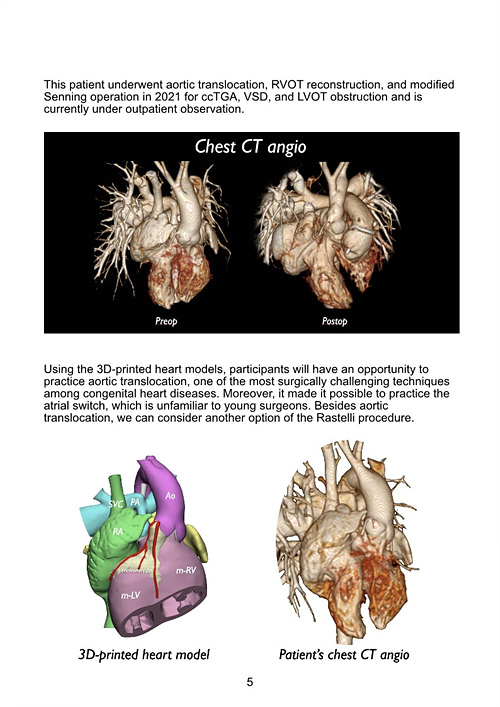 APCIS News - APCIS2022 C5-2 anatomic repair of cc-TGA VSD LVOT using 3d ...
