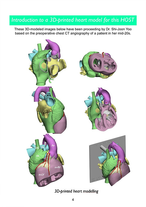 APCIS News - APCIS2022 C5-2 anatomic repair of cc-TGA VSD LVOT using 3d ...